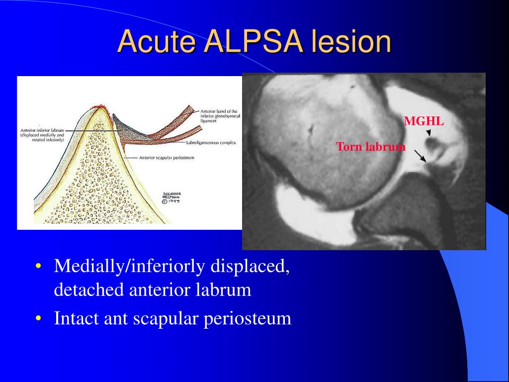 PPT - Shoulder Dyslexia: The Alphabet Soup Alison Nguyen 4/13/06 ...