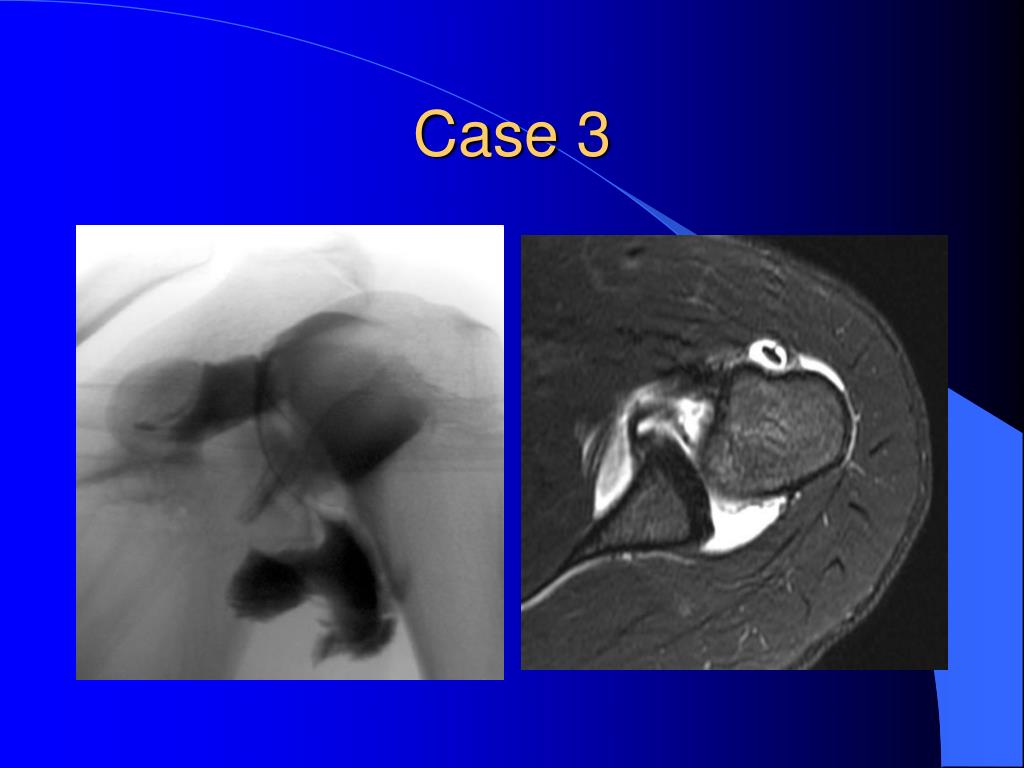 PPT - Shoulder Dyslexia: The Alphabet Soup Alison Nguyen 4/13/06 ...