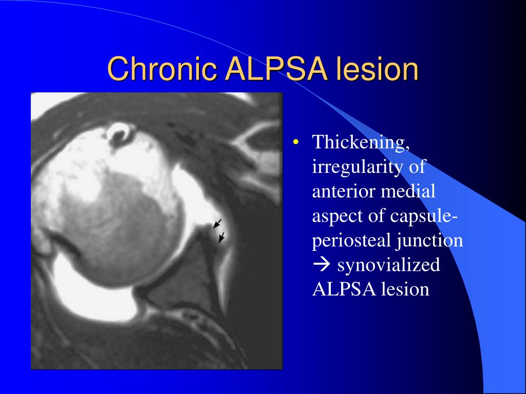 PPT - Shoulder Dyslexia: The Alphabet Soup Alison Nguyen 4/13/06 ...