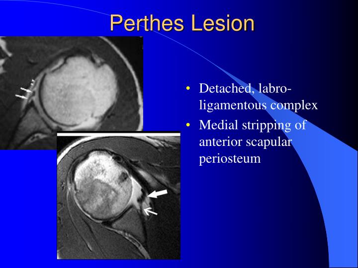 PPT - Shoulder Dyslexia: The Alphabet Soup Alison Nguyen 4/13/06 ...