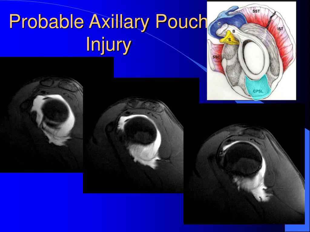PPT - Shoulder Dyslexia: The Alphabet Soup Alison Nguyen 4/13/06 ...