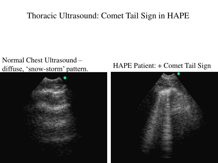 PPT - Normal Chest Ultrasound – diffuse, ‘snow-storm’ pattern ...