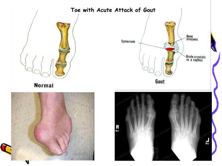 PPT - Uric acid PowerPoint Presentation - ID:3568648