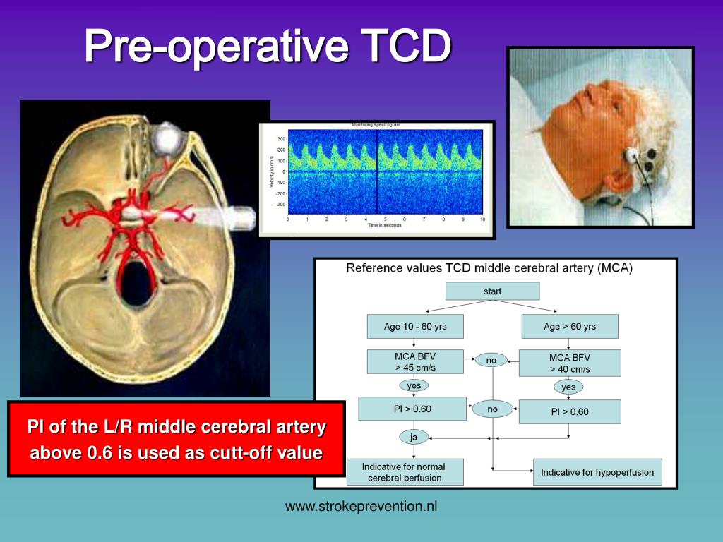 PPT - Stroke and Delirium prevention in CABG Surgery ‘the Haga Brain ...
