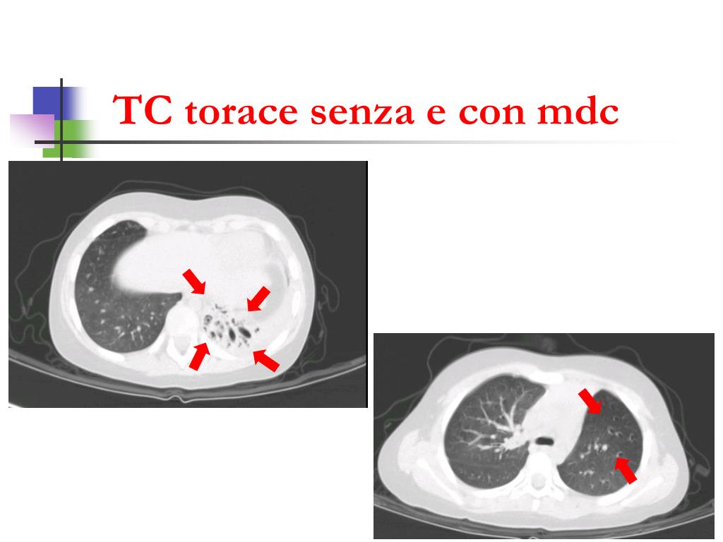 PPT - Un caso di polmoniti ricorrenti PowerPoint Presentation, free ...