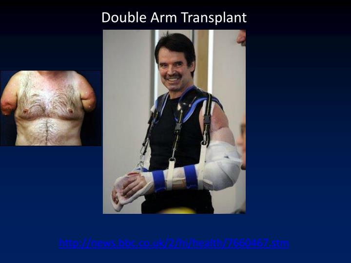 PPT - Double Arm Transplant PowerPoint Presentation, free download - ID ...