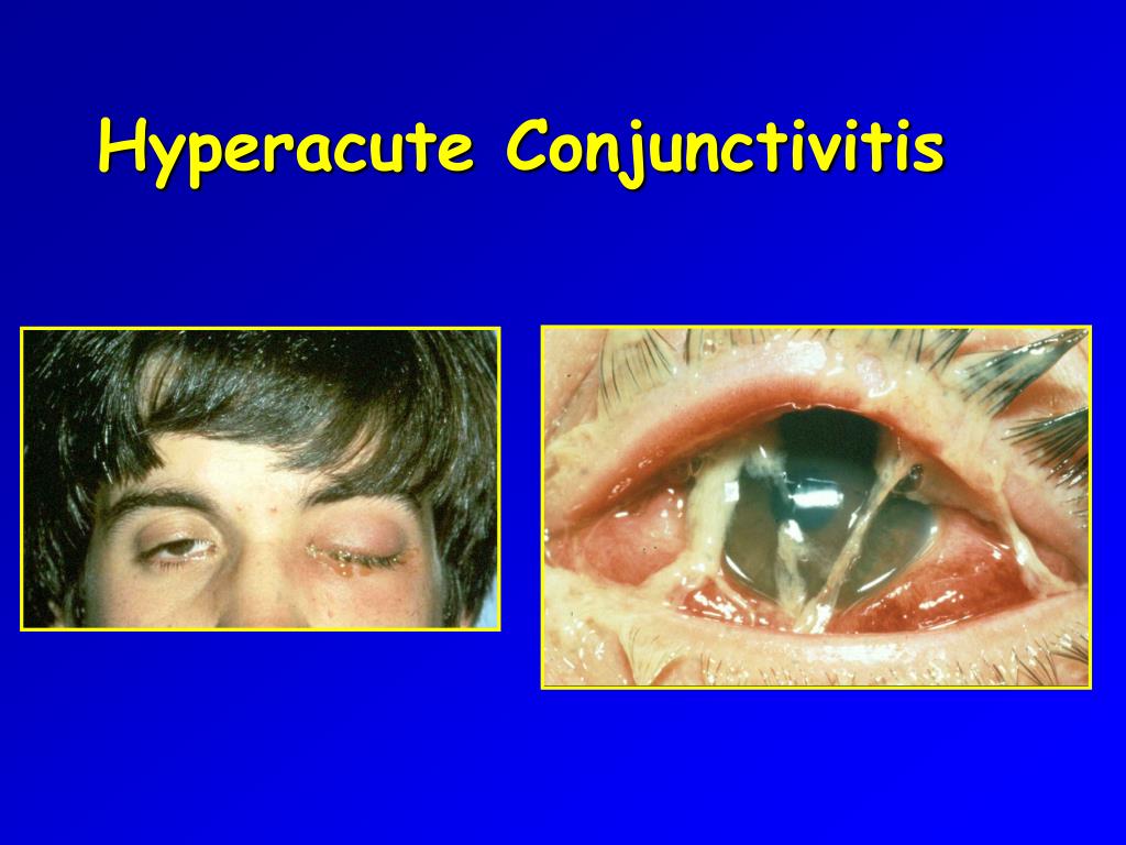 PPT - Hyperacute Conjunctivitis with Corneal Melting d/t Neisseria go ...