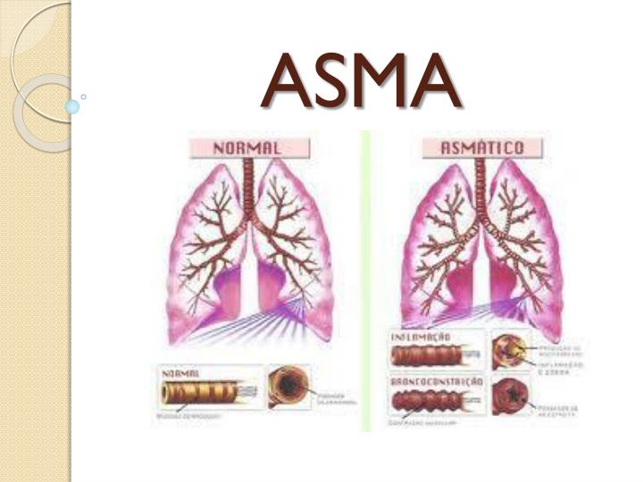 PPT - ASMA PowerPoint Presentation, free download - ID:3576484