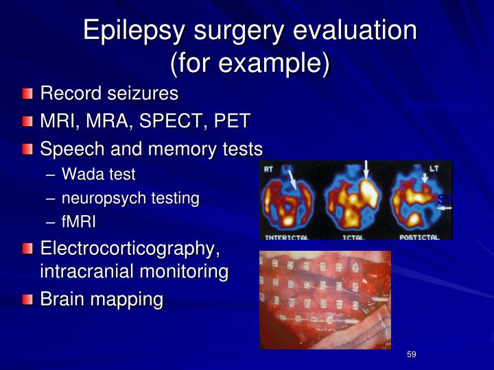 PPT - Pediatric Epilepsy: An Overview and Update on Treatment Options ...