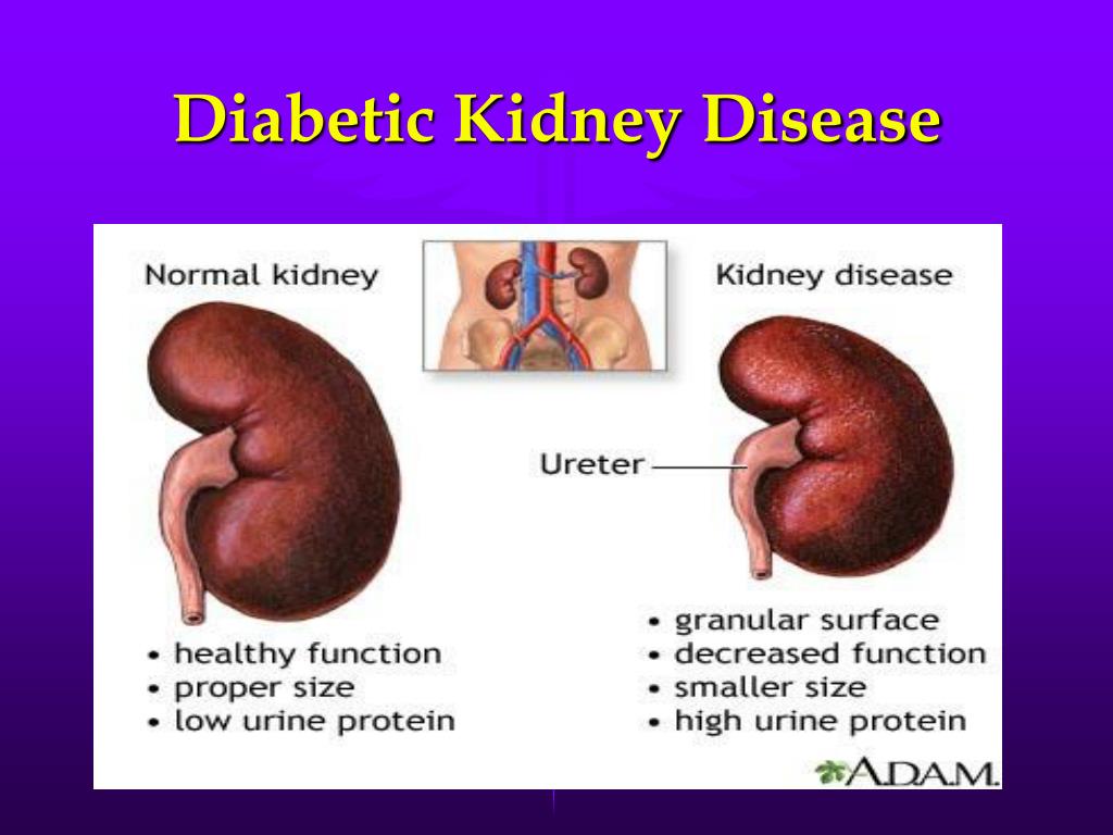PPT - Chronic Kidney Disease What You Need to Know PowerPoint ...