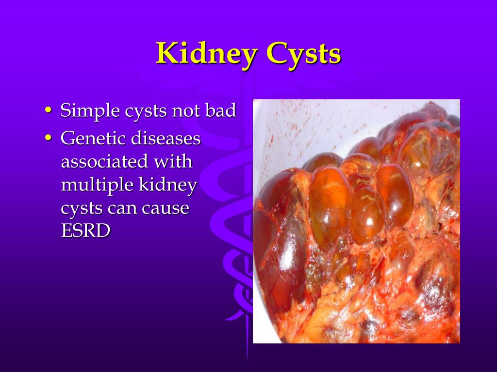 PPT - Chronic Kidney Disease What You Need to Know PowerPoint ...