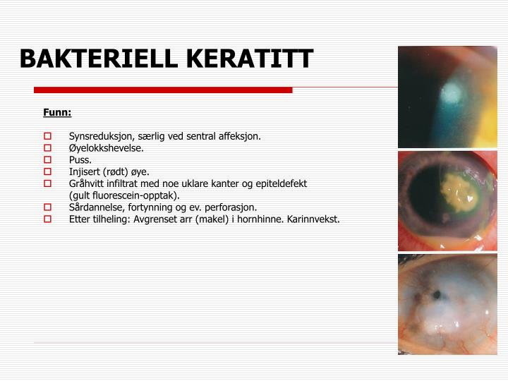 PPT - AKUTTE ØYELIDELSER PowerPoint Presentation - ID:3583402