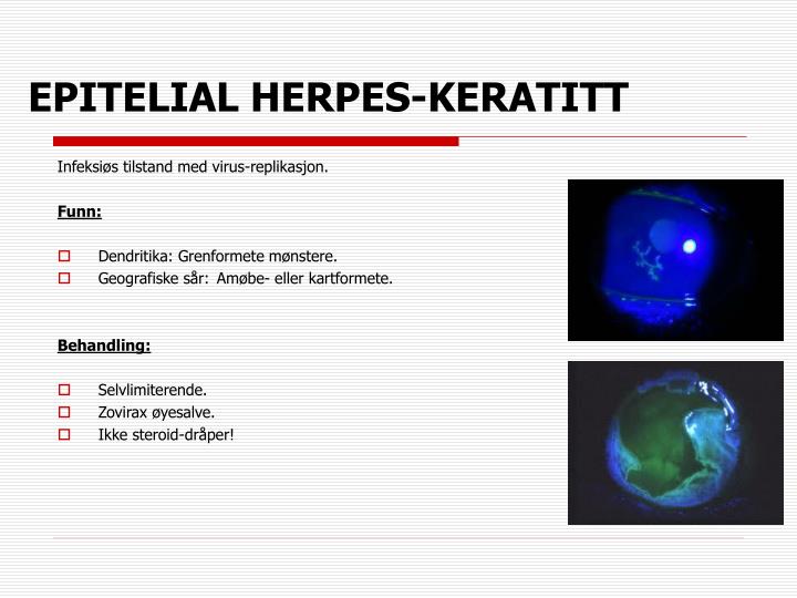 PPT - AKUTTE ØYELIDELSER PowerPoint Presentation - ID:3583402