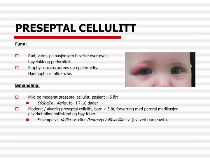PPT - AKUTTE ØYELIDELSER PowerPoint Presentation - ID:3583402