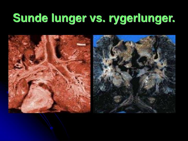 PPT - Lunger PowerPoint Presentation - ID:3583957
