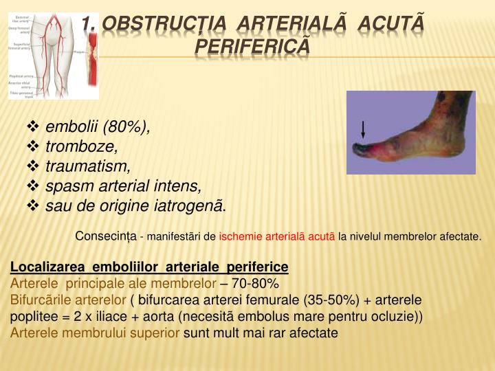 PPT - SINDROMUL DE ISCHEMIE ACUTÃ PERIFERICÃ ARTERIOPATIA PERIFERICĂ ...
