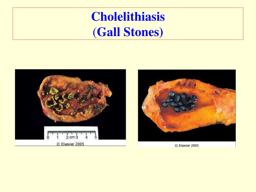 PPT - MC congenital anomalies = abnormal variants of the gallbladder MC ...