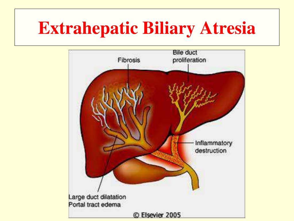 PPT - MC congenital anomalies = abnormal variants of the gallbladder MC ...