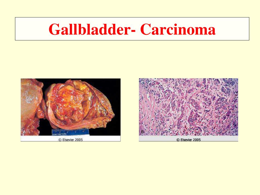 PPT - MC congenital anomalies = abnormal variants of the gallbladder MC ...