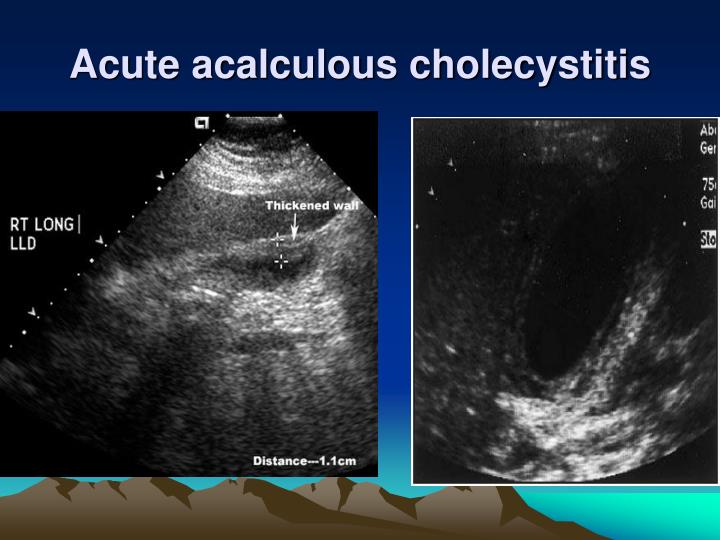 PPT - Pathology of the gall bladder and biliary tree PowerPoint ...