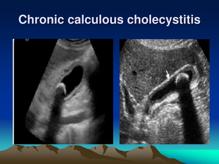 PPT - Pathology of the gall bladder and biliary tree PowerPoint ...