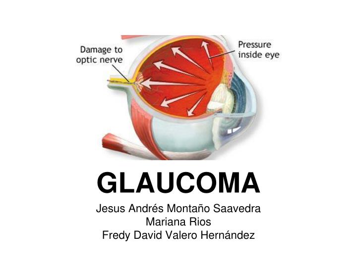 PPT - GLAUCOMA PowerPoint Presentation, free download - ID:3588103
