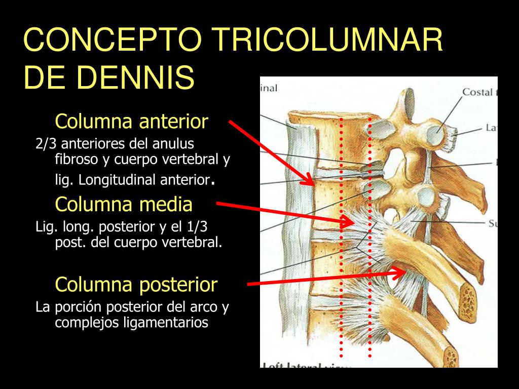 PPT - PATOLOGÍA TRAUMÁTICA DE COLUMNA Dr. Patricio Alegría Velis ...