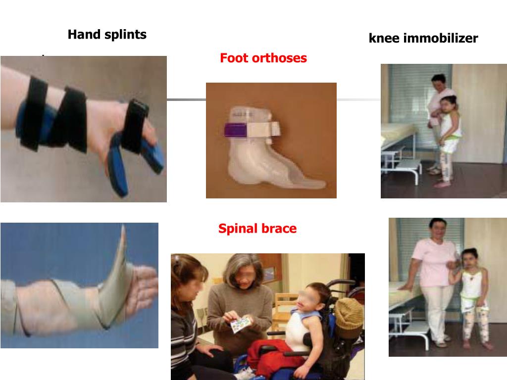 PPT - Management of Cerebral Palsy (Treatment) PowerPoint Presentation ...