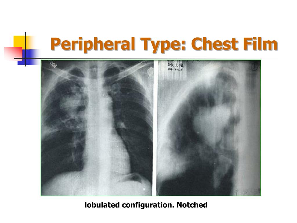 PPT - Primary Bronchogenic Carcinoma (LUNG CANCER) PowerPoint ...
