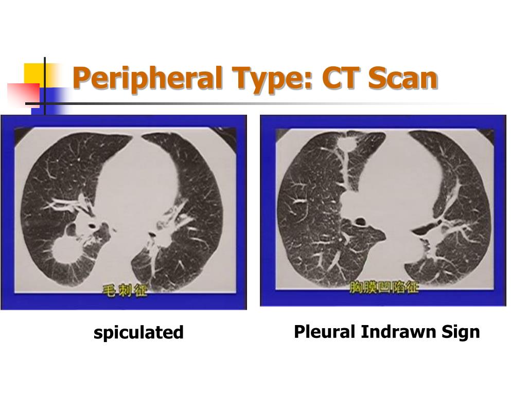 PPT - Primary Bronchogenic Carcinoma (LUNG CANCER) PowerPoint ...