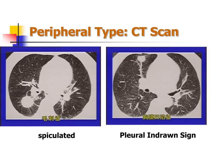 PPT - Primary Bronchogenic Carcinoma (LUNG CANCER) PowerPoint ...