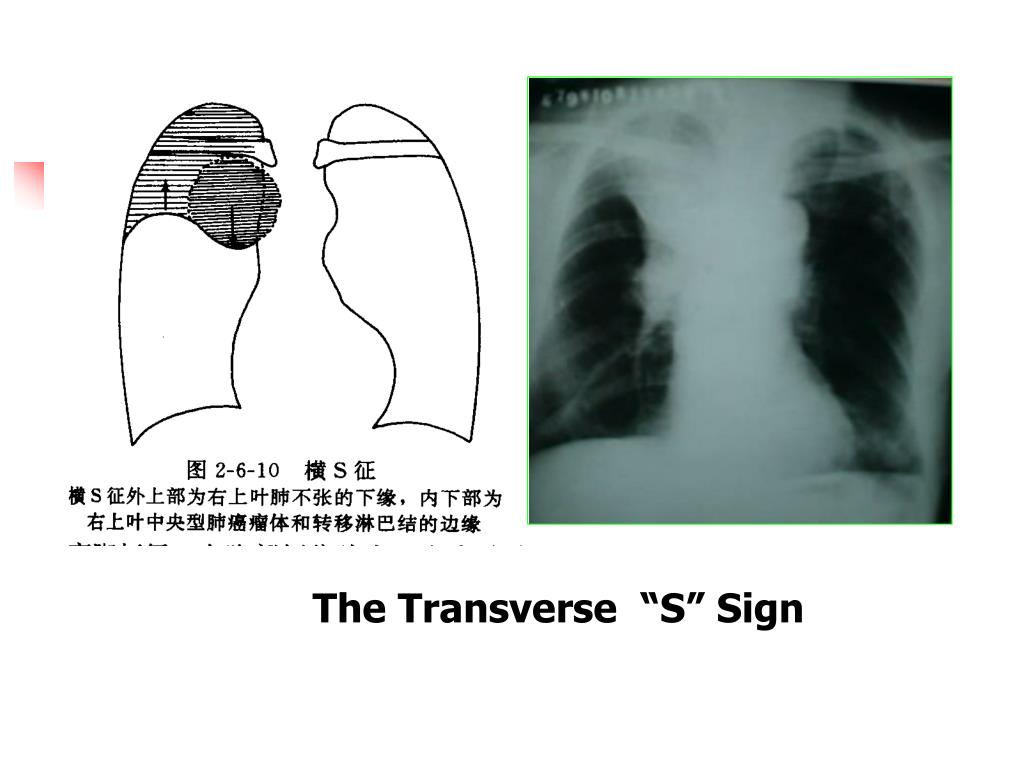 PPT - Primary Bronchogenic Carcinoma (LUNG CANCER) PowerPoint ...