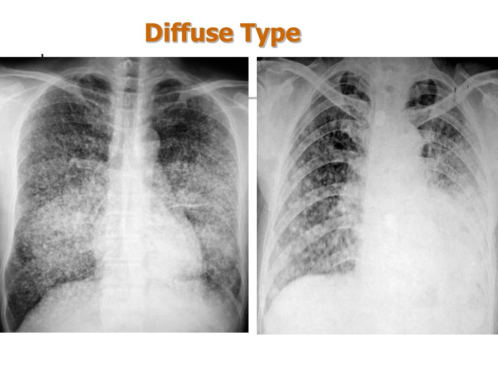 PPT - Primary Bronchogenic Carcinoma (LUNG CANCER) PowerPoint ...