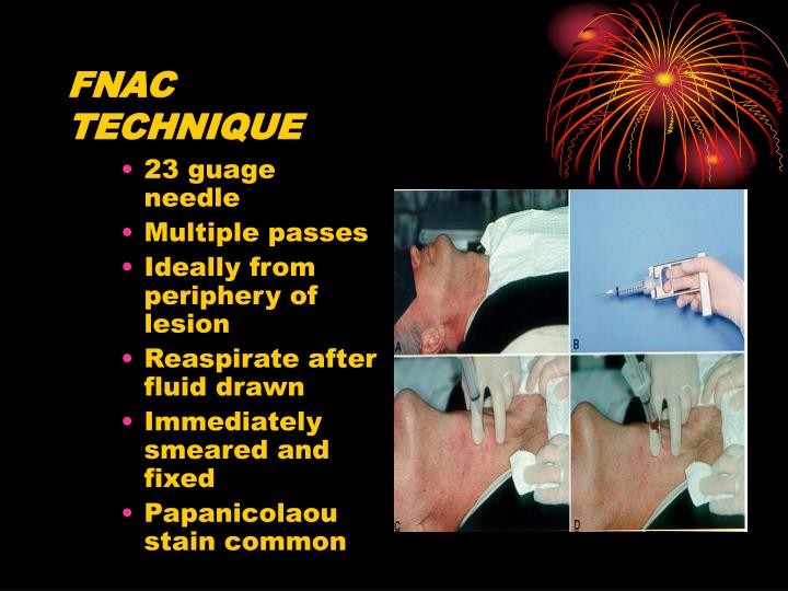 PPT - Solitary nodule of thyroid PowerPoint Presentation - ID:3594143
