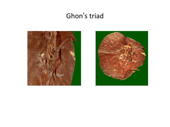 PPT - PULMONARY TUBERCULOSIS PowerPoint Presentation - ID:3595407