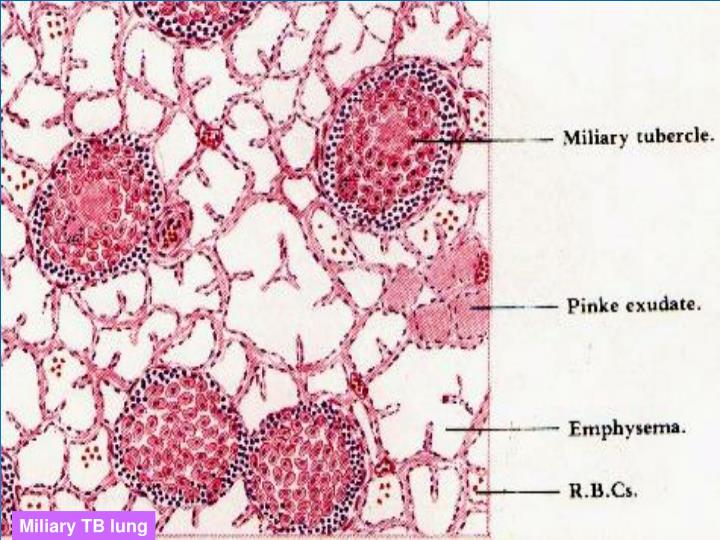 PPT - Lung Pathology TUBERCULOSIS PowerPoint Presentation - ID:3595637