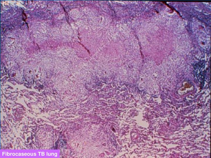 PPT - Lung Pathology TUBERCULOSIS PowerPoint Presentation - ID:3595637