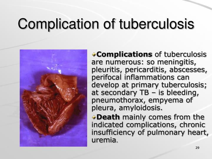 PPT - Pathological anatomy of TUBERCULOSIS PowerPoint Presentation - ID ...