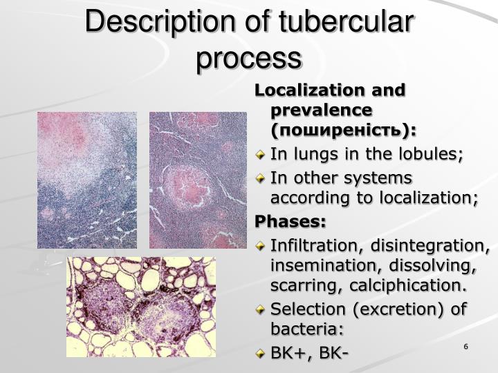 PPT - Pathological anatomy of TUBERCULOSIS PowerPoint Presentation - ID ...