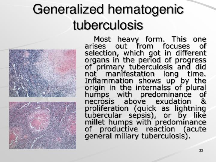 PPT - Pathological anatomy of TUBERCULOSIS PowerPoint Presentation - ID ...