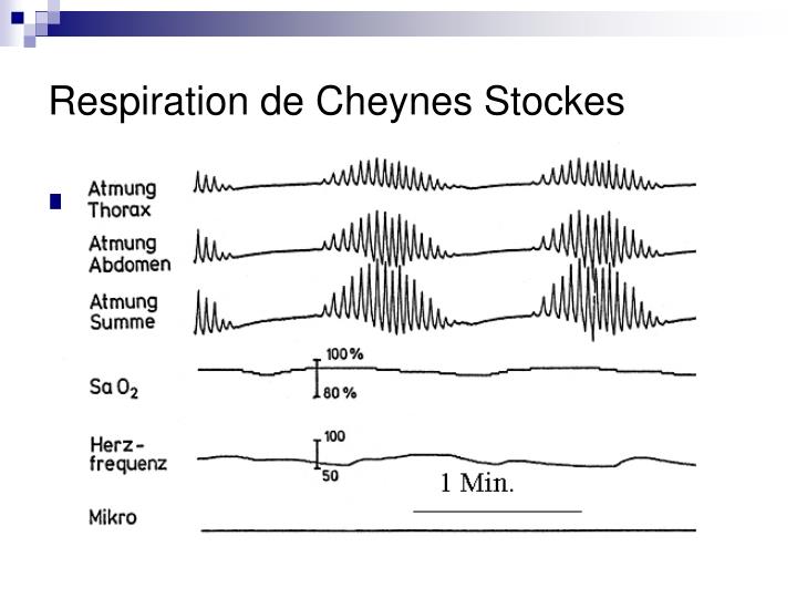 PPT - Syndrome d’apnée du sommeil PowerPoint Presentation - ID:3598372