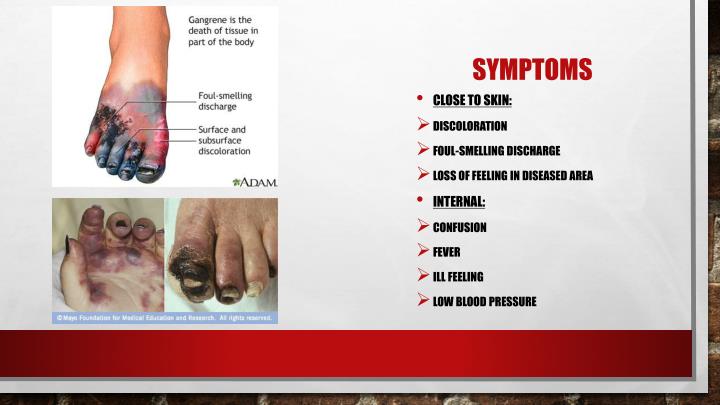 PPT - Gangrene PowerPoint Presentation - ID:3599464