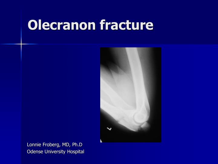 PPT - Olecranon fracture PowerPoint Presentation, free download - ID ...