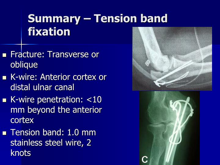 PPT - Olecranon fracture PowerPoint Presentation - ID:3602645
